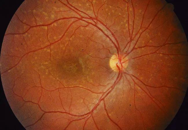 Gene Therapy for Inherited Retinal Dystrophies