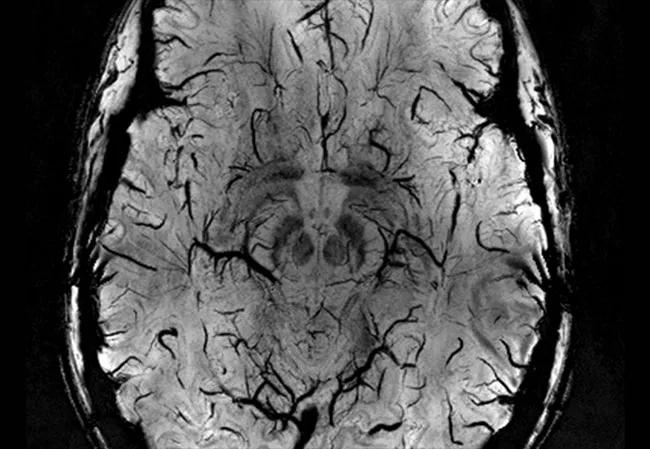 Podcast: 7T MRI for Various Neurological Conditions