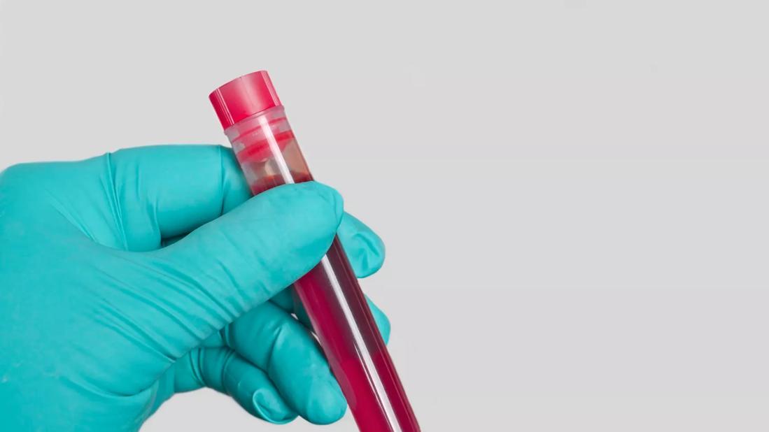 Cleveland Clinic Joins Study to Evaluate Blood Test Designed to Detect ...
