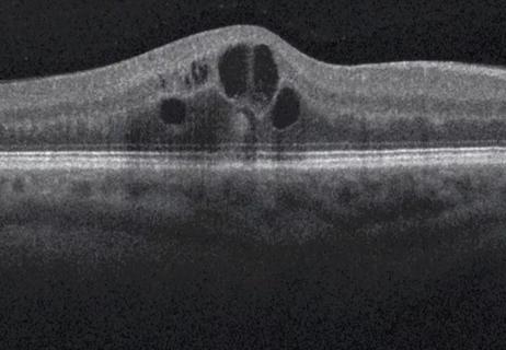Macular Edema Oct Diabetic Macular Edema, OCT Scan | Stock Image