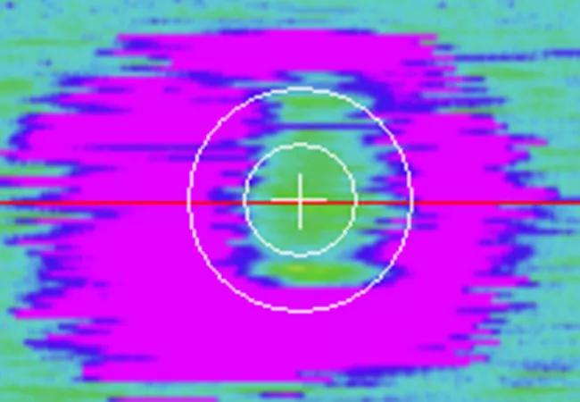 Novel Image Analysis Platform May Detect Early Signs of Retinal ...