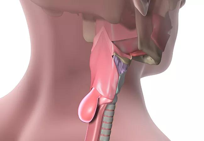 1-Minute Consult: Are There Alternatives to Surgery for Zenker ...