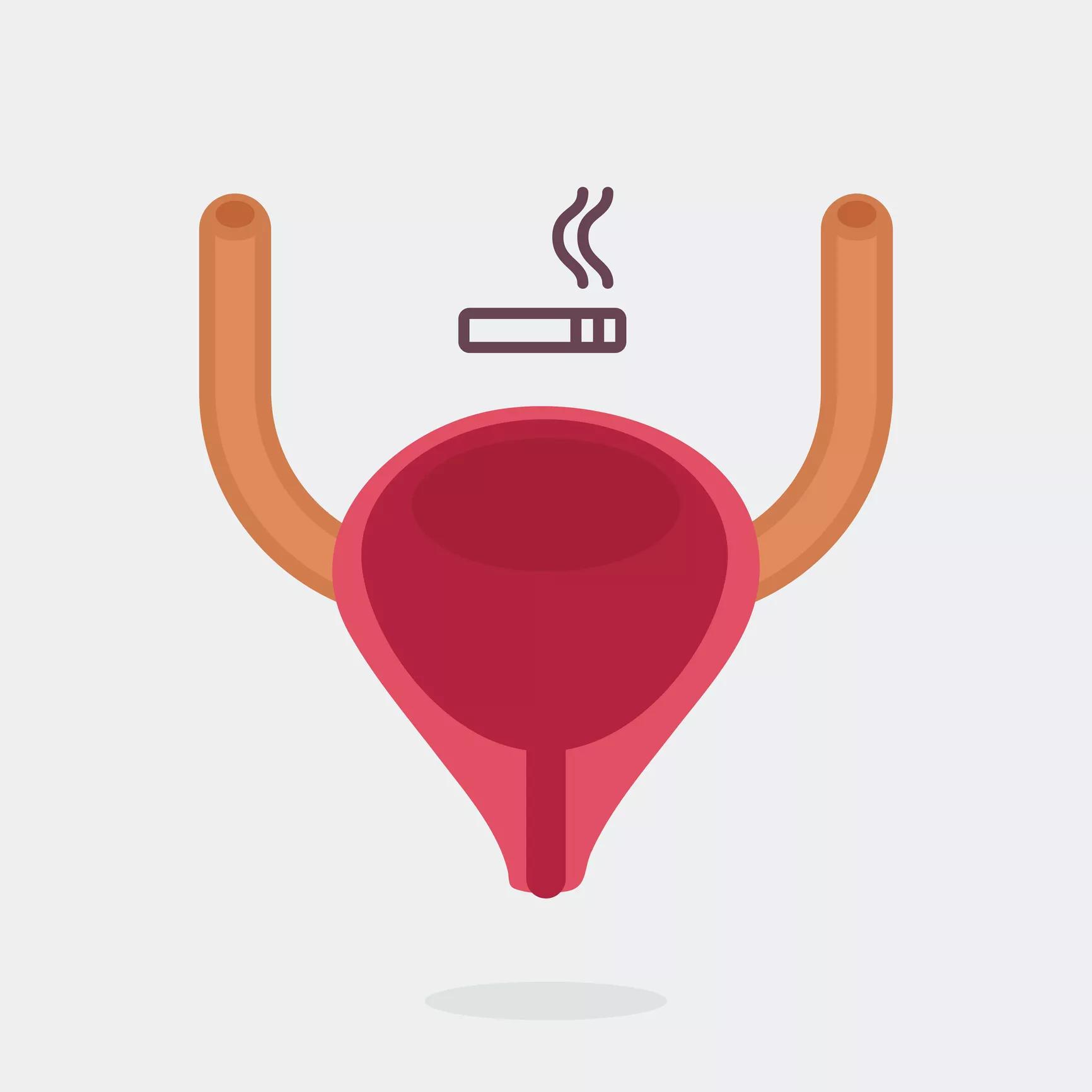 Surprising Link: Smoking and Bladder Cancer