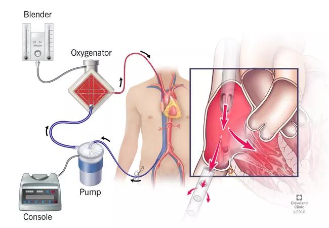 Extracorporeal Membrane Oxygenation Extracorporeal Membrane