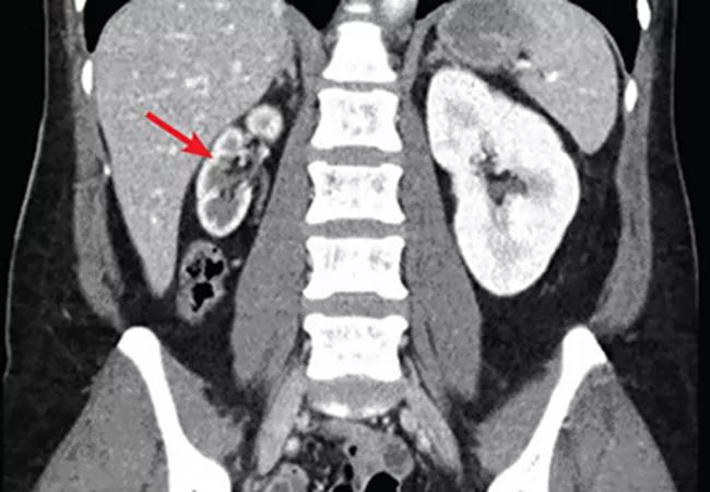 Unilateral Atrophic Kidney in a 45-Year-Old Woman