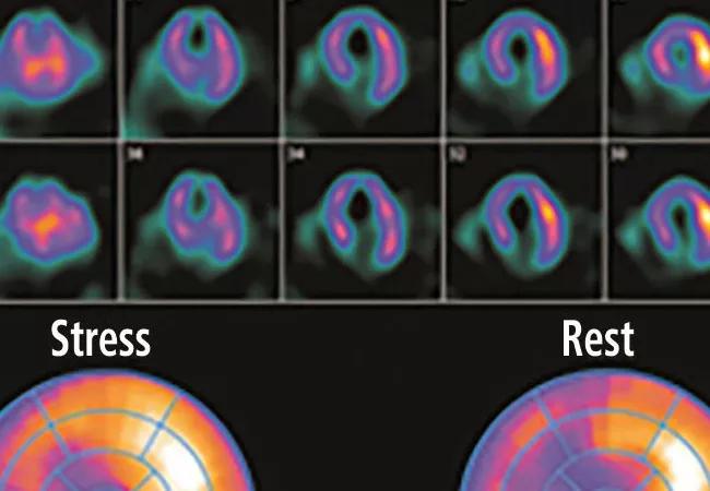 Abnormal Stress Test Acute MI After A Normal Stress Test Journal Of